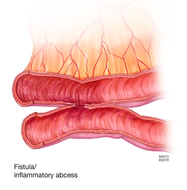 Crohn’s Disease | Mayo Clinic Business Development