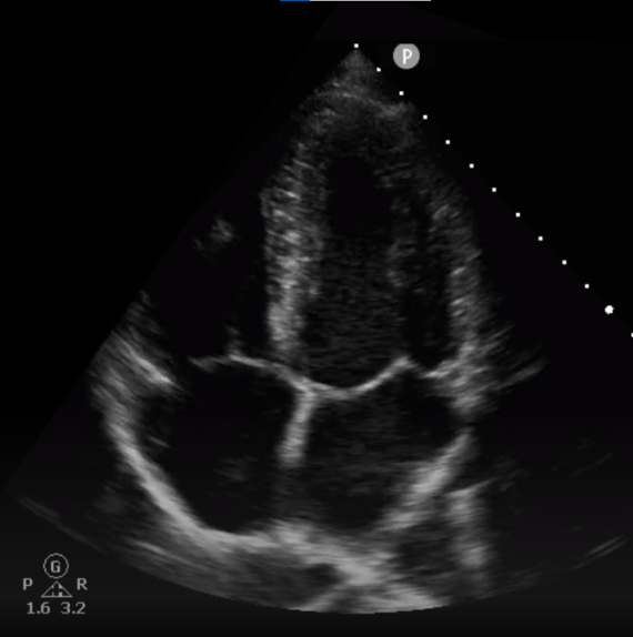 New AI Algorithm Screens for Heart Failure - Mayo Clinic Business ...